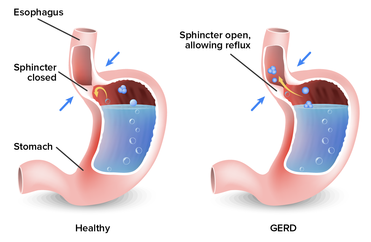 Health of the GI Tract Tutorial | Sophia Learning