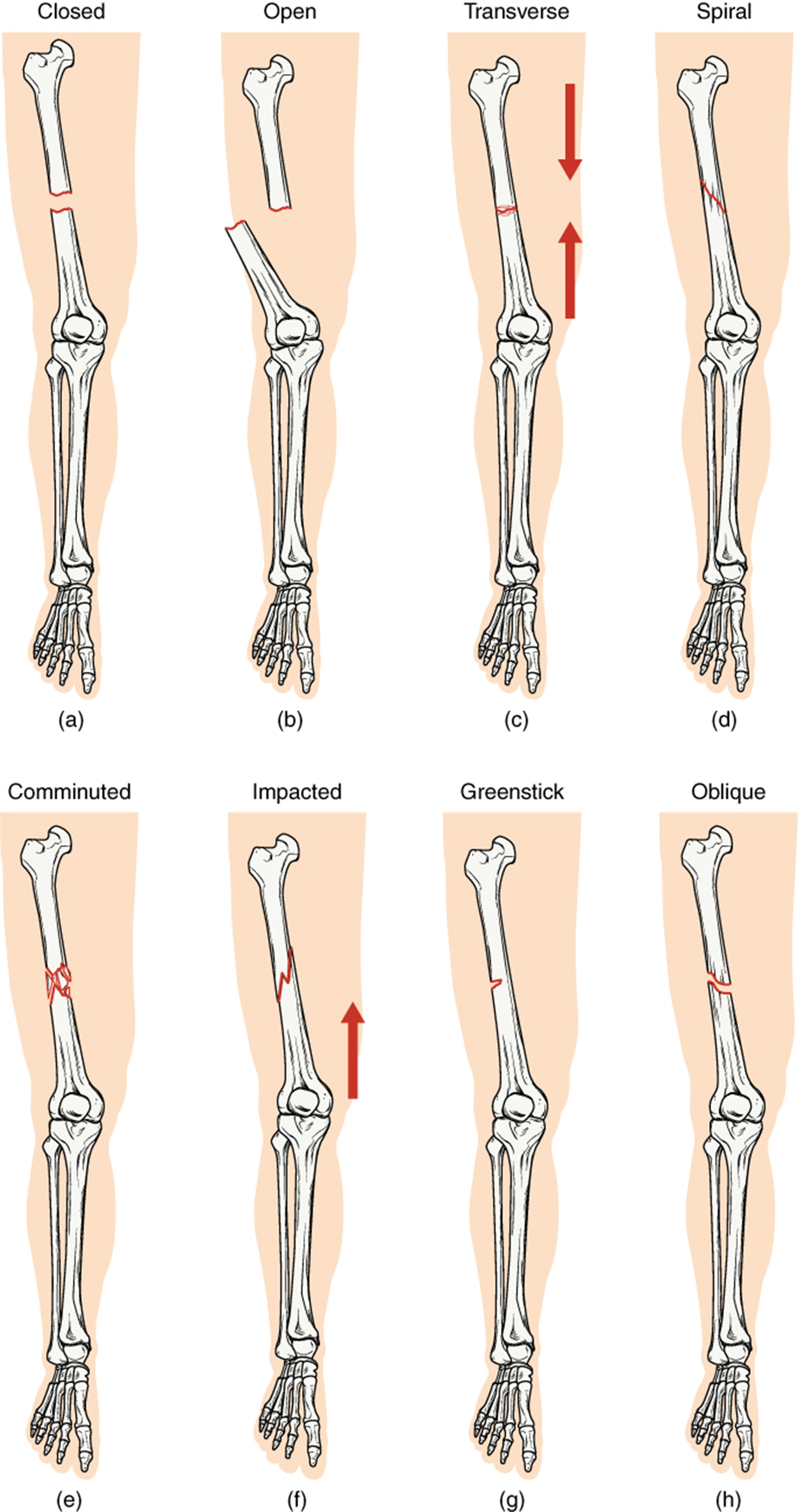Fractures: Bone Repair Tutorial | Sophia Learning