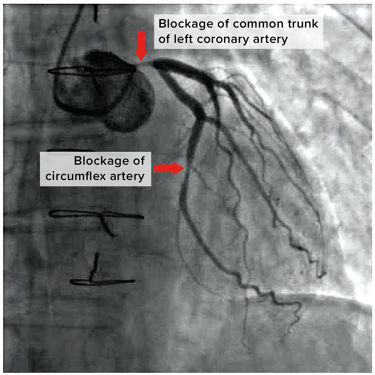 Non-cardiac Cardiovascular System Disorders Tutorial | Sophia Learning