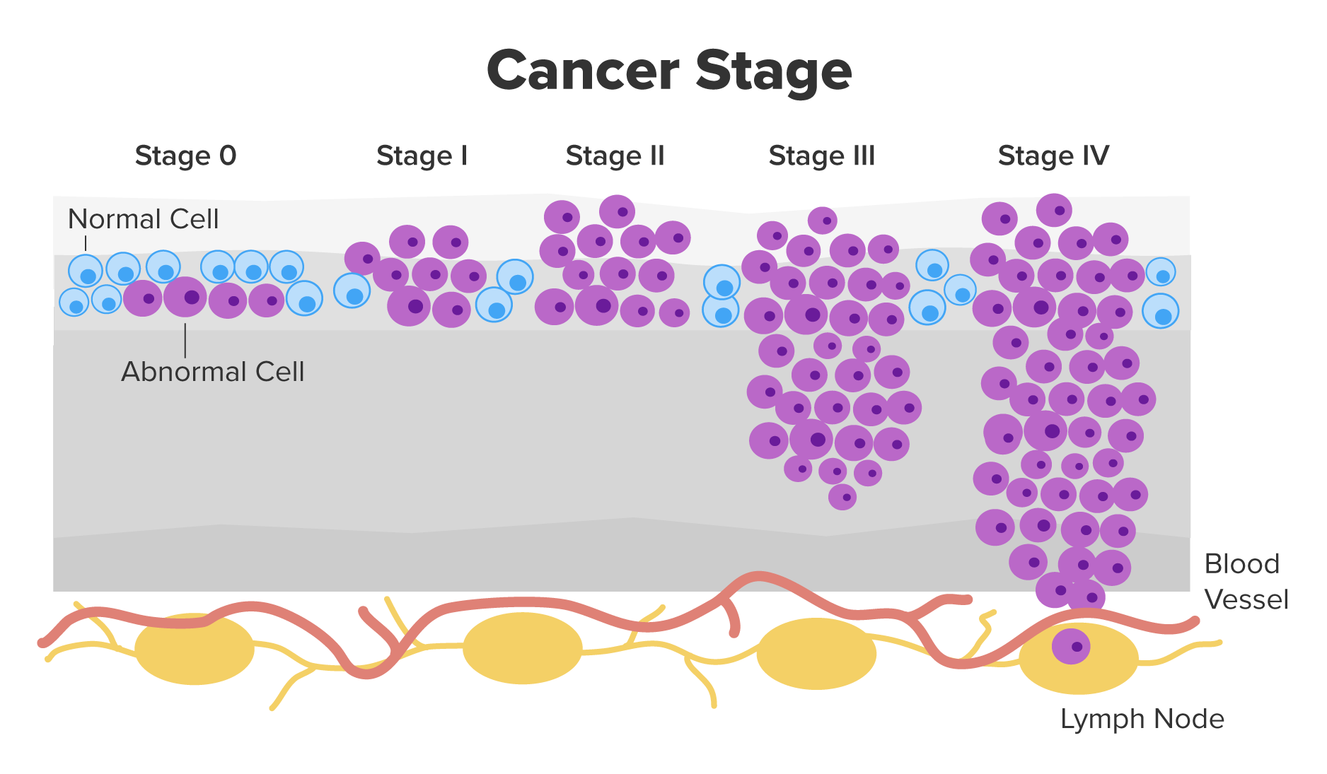 Grading and Staging Cancer Tutorial | Sophia Learning